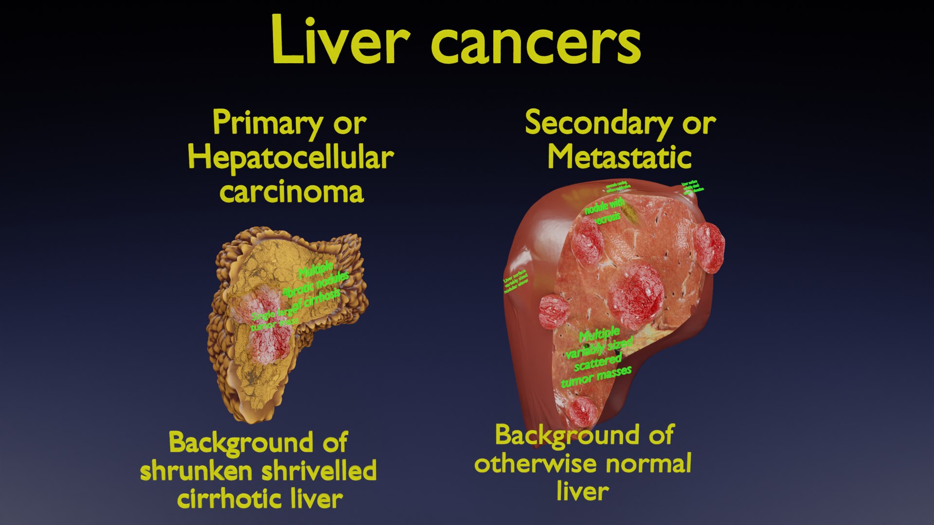 Liver cancer HCC vs Metastatic 3D model - Blender Market