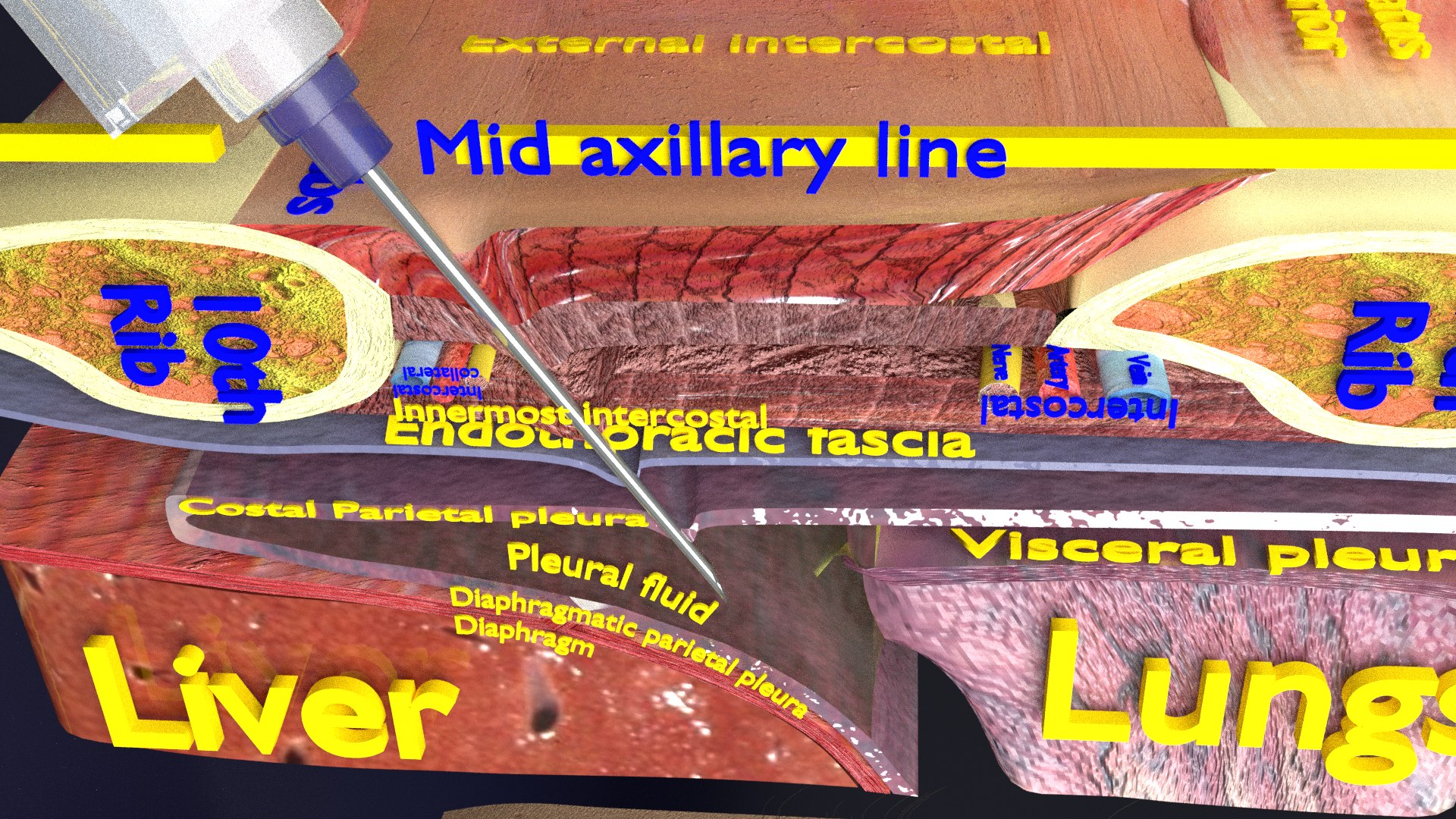 Thorax Thoracotomy Thoracocentesis Intercostal Nerve Block 3d Model